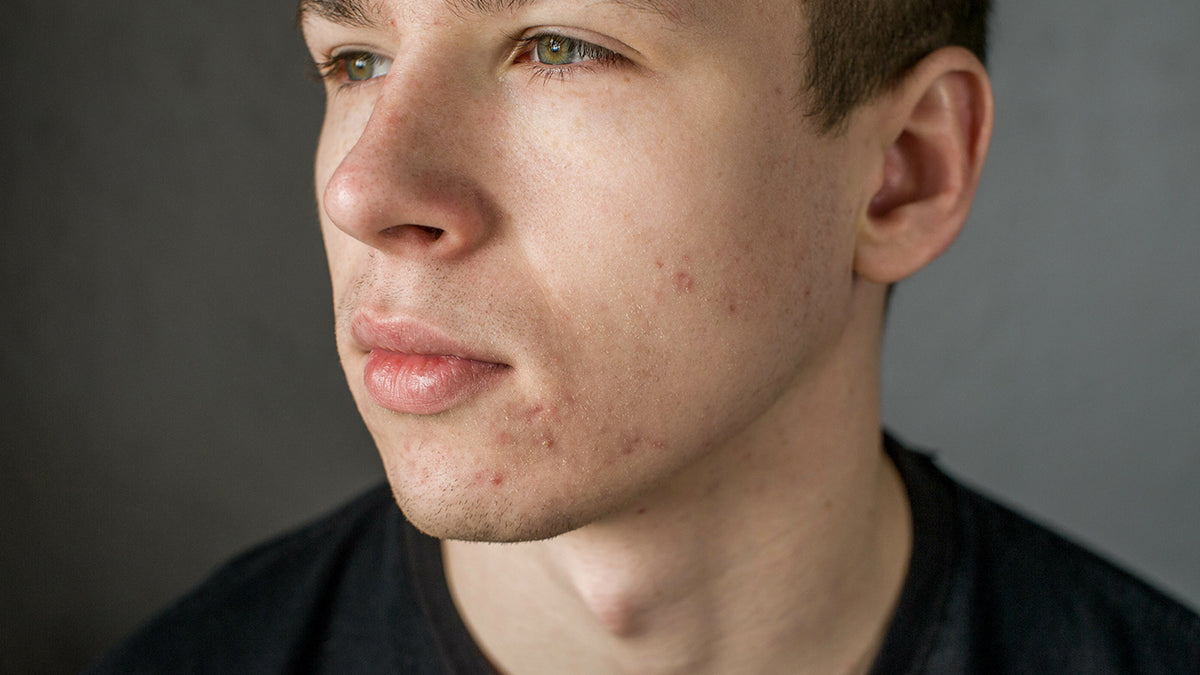 TOP 5 SKIN CONDITIONS THAT CAN MASSIVELY AFFECT YOUR CONFIDENCE AS A M ...